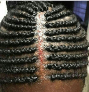 Why Tight Braids Cause Bumps | Nathairdiva Resources